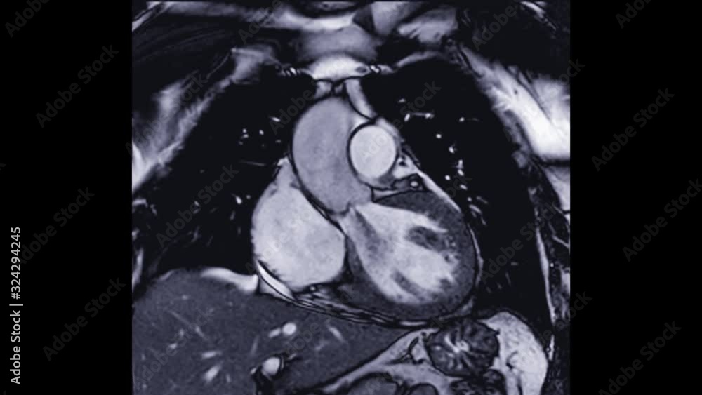 MRI heart or Cardiac MRI magnetic resonance imaging of heart in LVOT ...