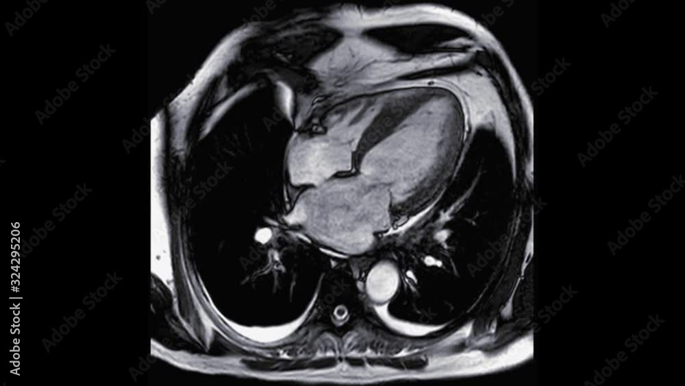 MRI heart or Cardiac MRI magnetic resonance imaging of heart in 4 ...