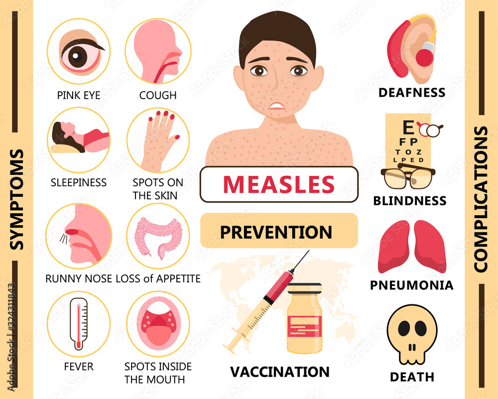 Measles infographic concept vector. Infected human with papules on the ...