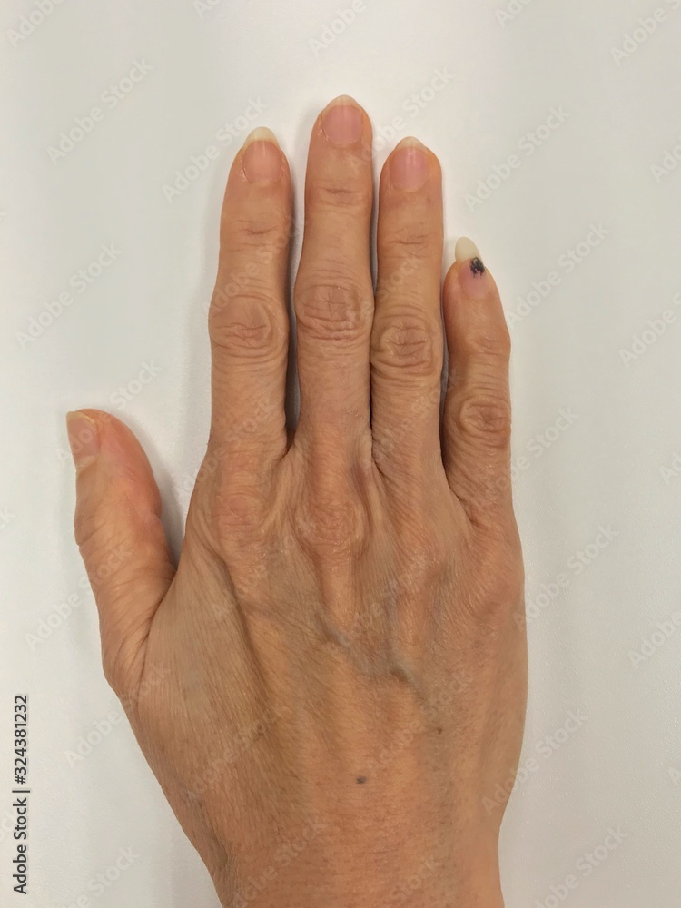 The subungual hematoma is occured like bleeding and bruising to ...