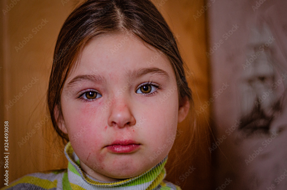 Sad girl child with hurt and scratches on the face from bump, insurance ...