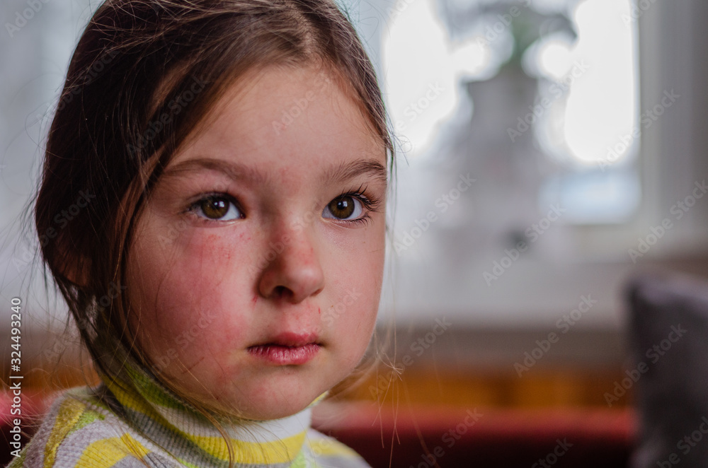 Sad girl child with hurt and scratches on the face from bump, insurance ...