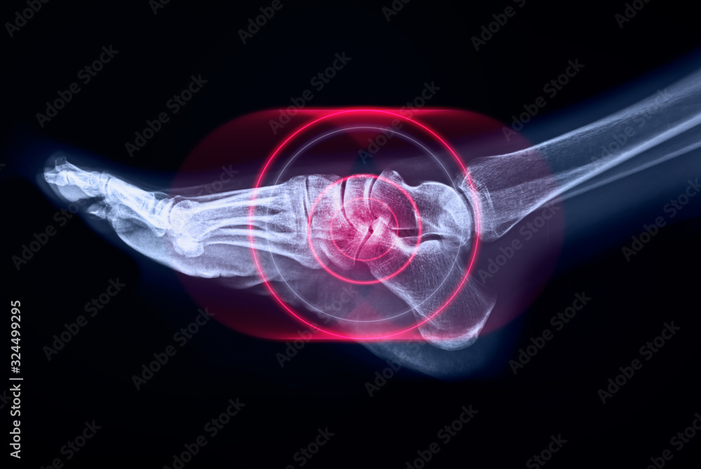 Foot pain on x-ray on black background Stock Photo | Adobe Stock