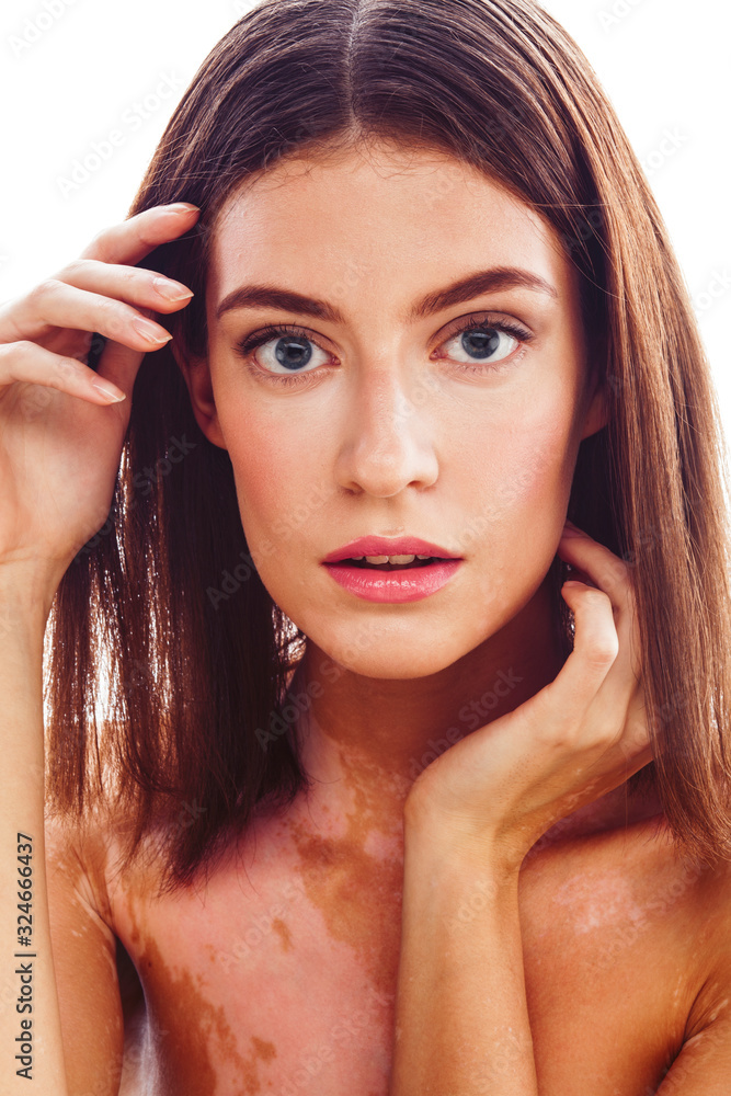 beautiful young brunette woman with vitiligo disease close up isolated ...