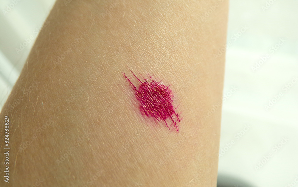 Wound on the skin of the hand treated with red ointment and hydrogen ...