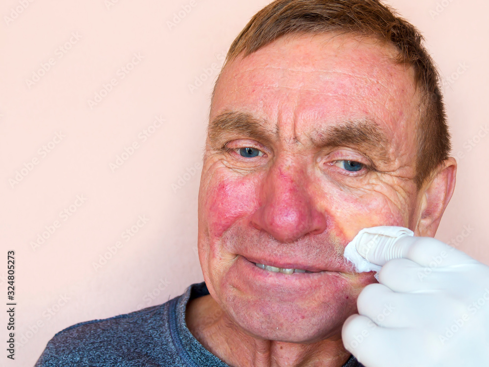 Demodecosis of the face. A man in gloves does the treatment of facial ...