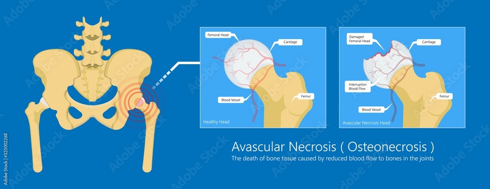 Avascular necrosis bone tissue disease Stock Vector | Adobe Stock