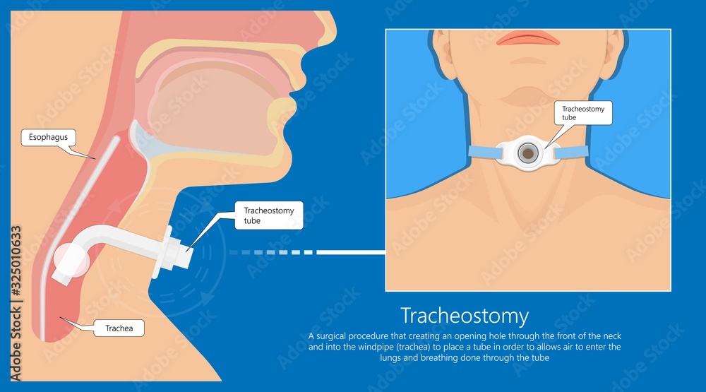 Tracheostomy tube medical procedure neck windpipe emergency breathing ...