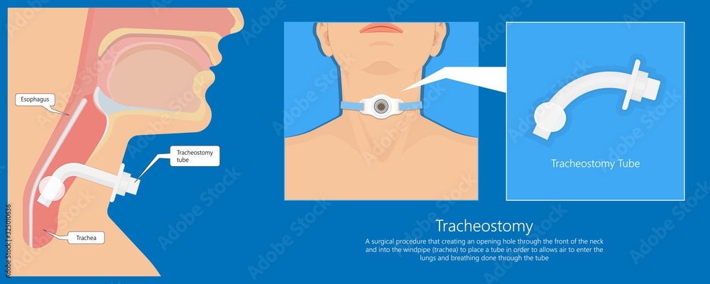 Emergency Tracheostomy