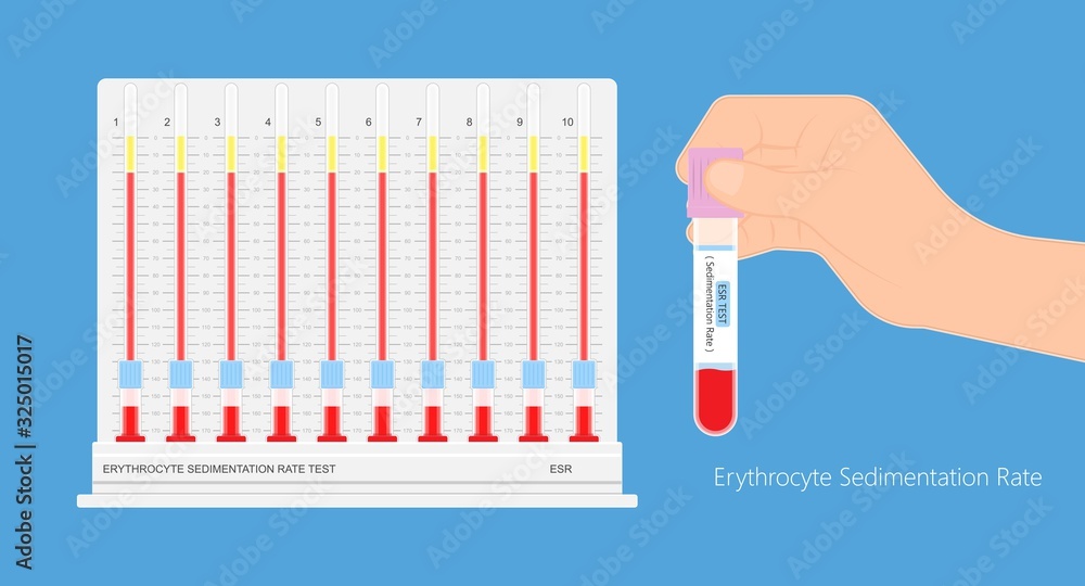 Erythrocyte Sedimentation Rate Test (ESR) Test blood diagnose ...