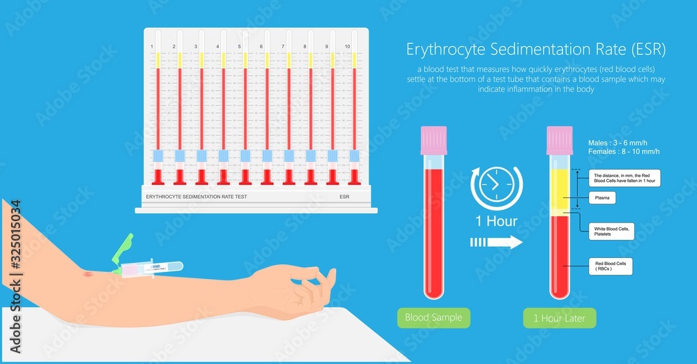 Erythrocyte Sedimentation Rate Test (ESR) Test blood diagnose ...
