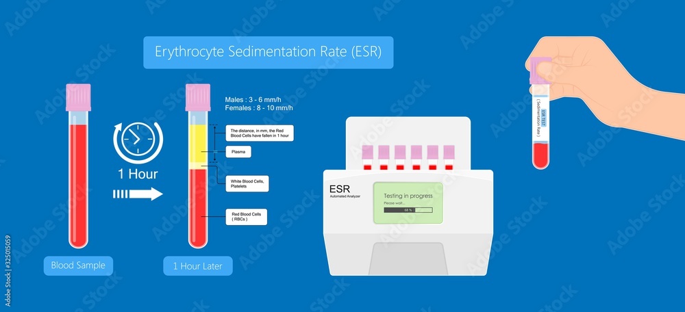 Erythrocyte Sedimentation Rate Test (ESR) Test blood diagnose ...