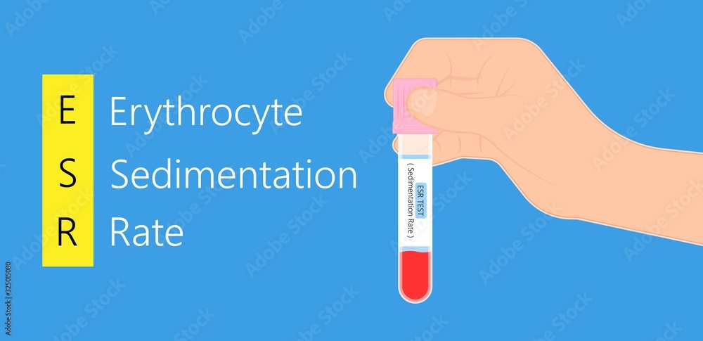 Erythrocyte Sedimentation Rate Test (ESR) Test blood diagnose ...