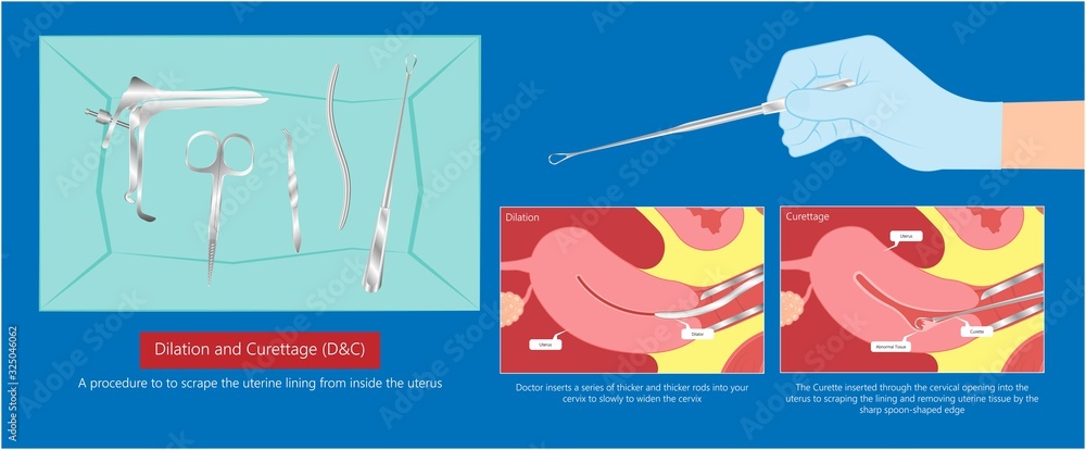 endometrial biopsy examination uterus procedure Stock Vector | Adobe Stock