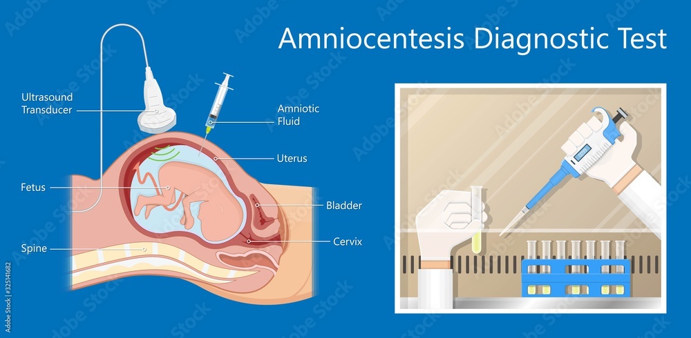 Poster Amniocentesis diagnostic test treat LAB analysis chromosome DNA ...