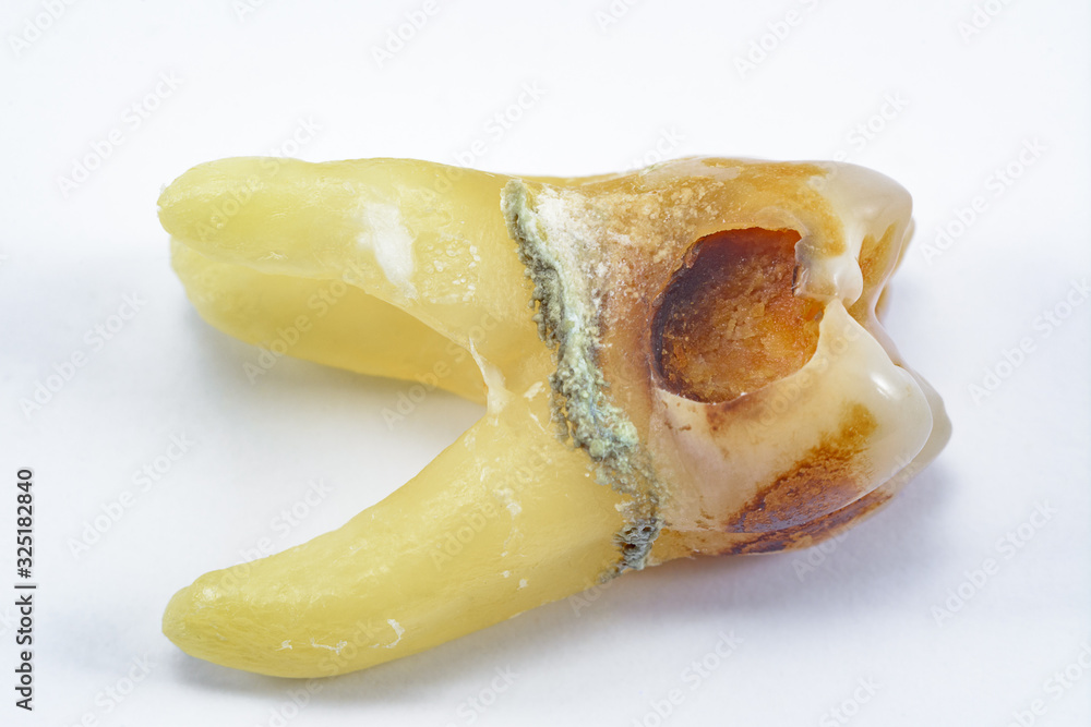 affected by caries, destroyed with a large cavity, removed human tooth ...