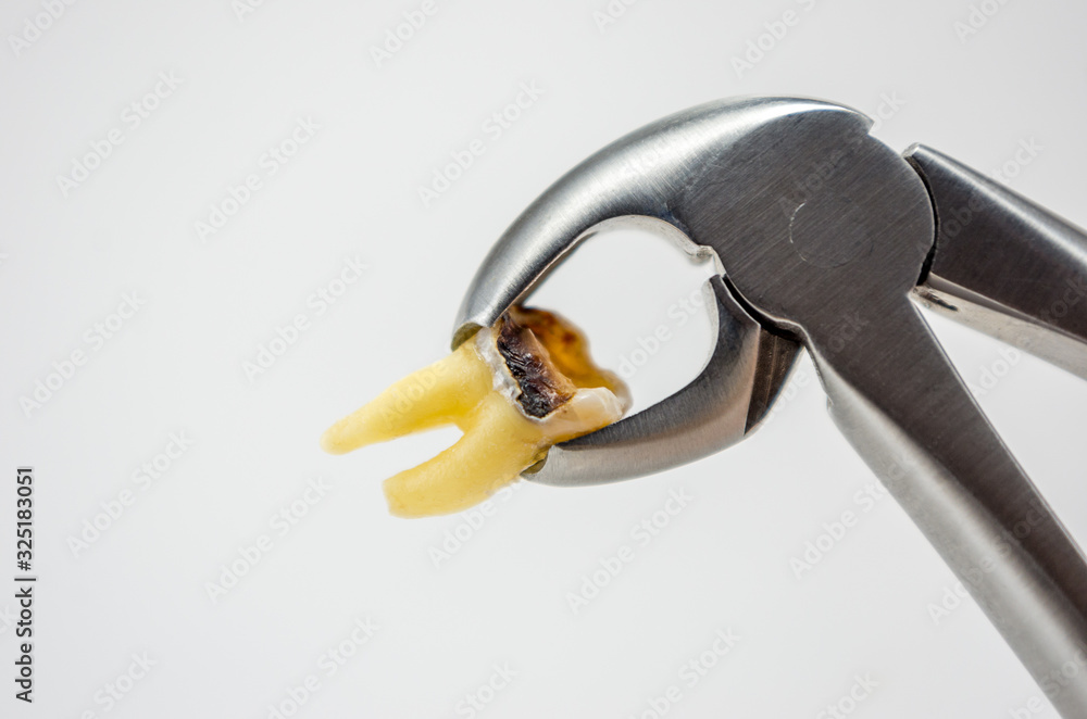 caries-affected destroyed with a large cavity removed human tooth in ...