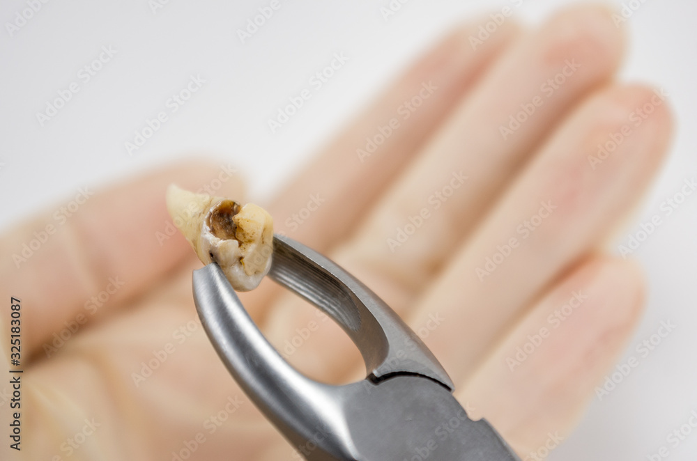 caries-affected destroyed with a large cavity removed human tooth in ...