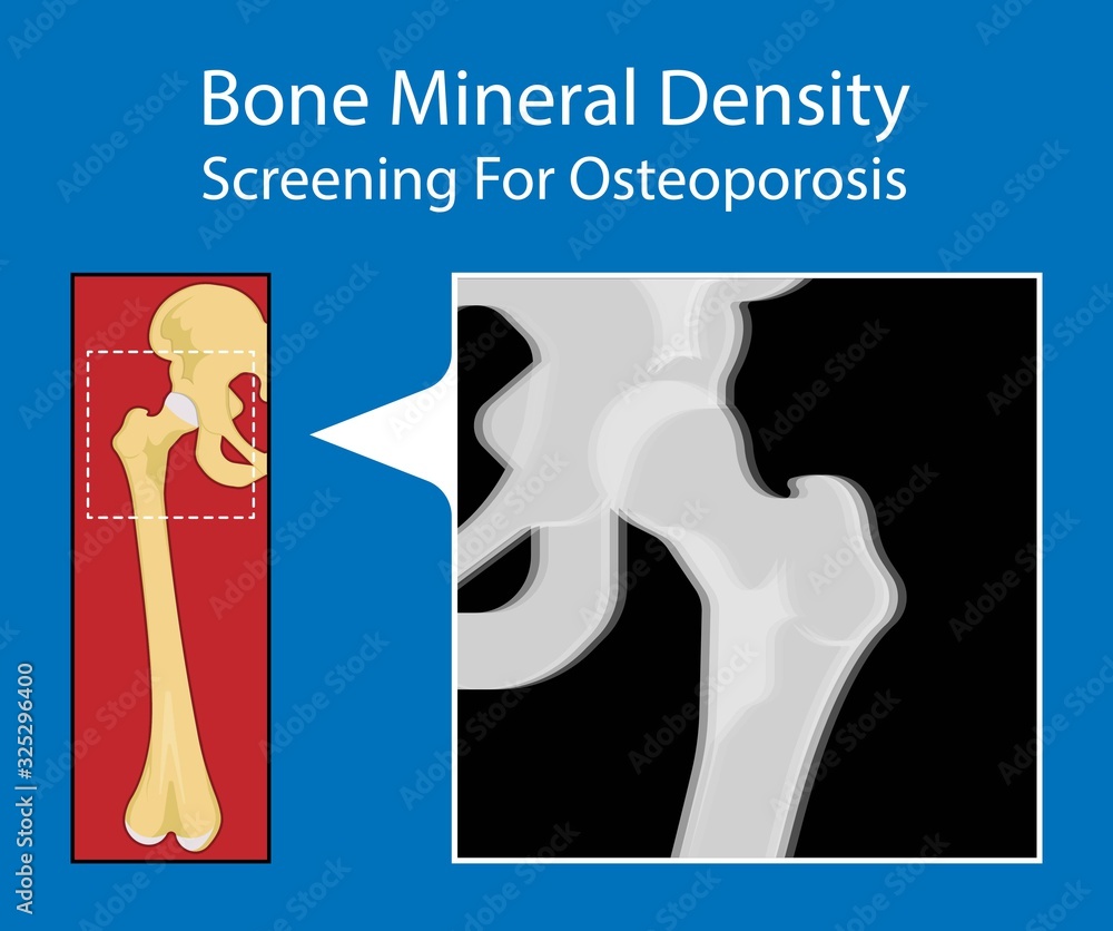 Bone mineral density BMD osteoporosis dual energy X-ray absorptionmetry ...