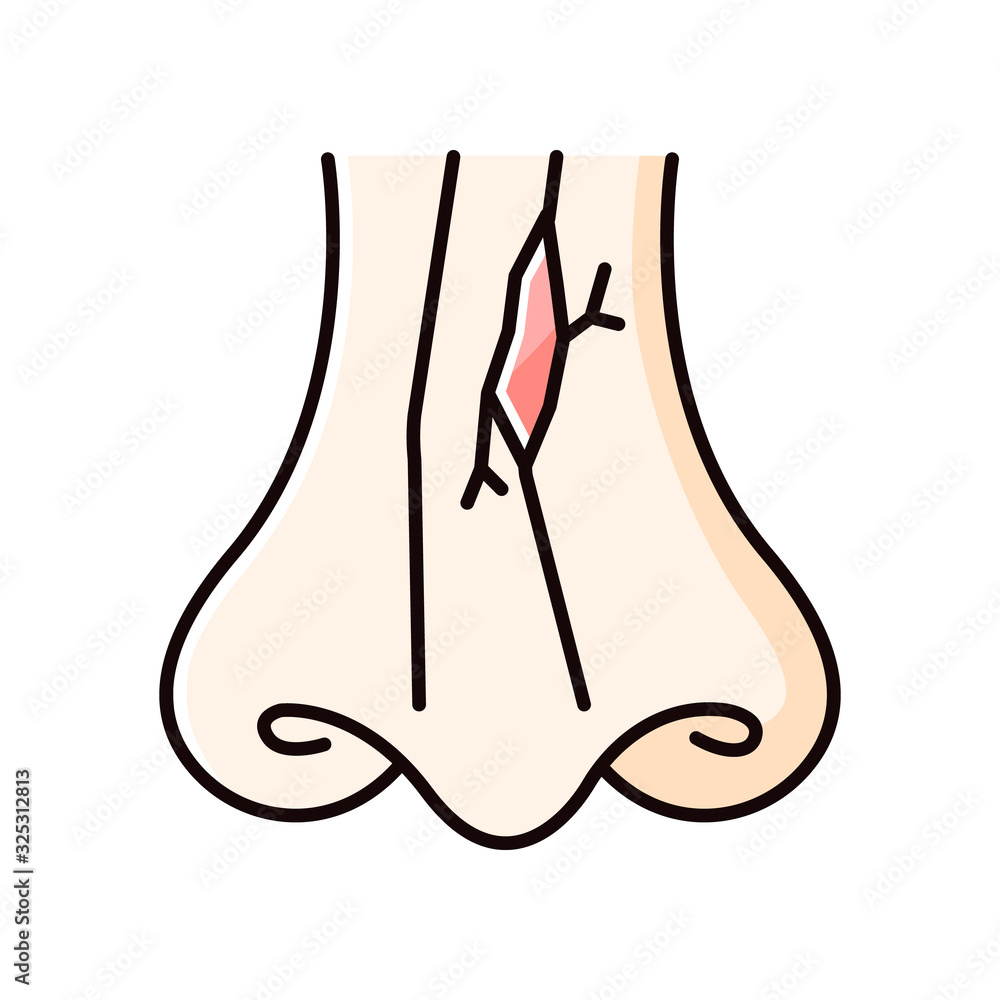 Nasal fracture RGB color icon. Broken nose bone. Crack in nose ...