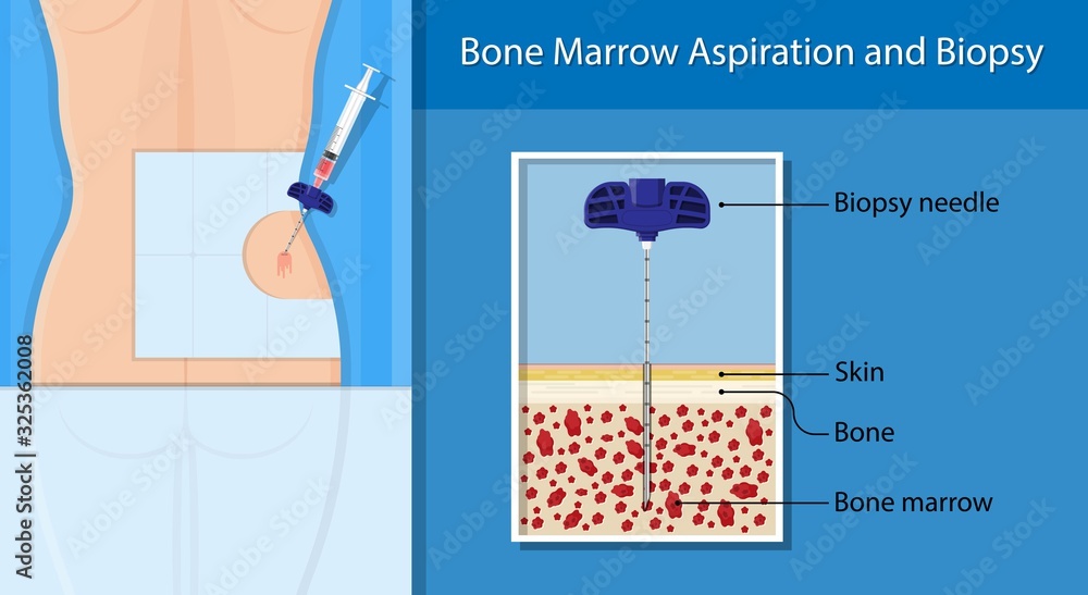 Bone biopsy medical marrow harvest stem cell transplants aspiration ...