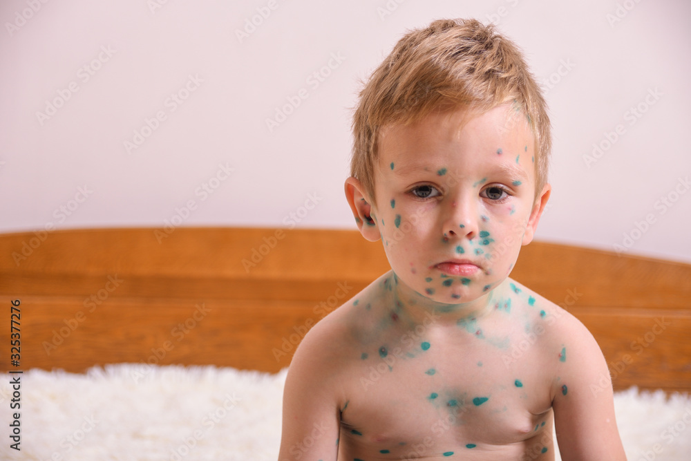 Young toddler,boy with chickenpox. Sick child with chickenpox ...