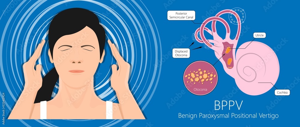 Benign paroxysmal positional vertigo BPPV loss balance dizzy ...