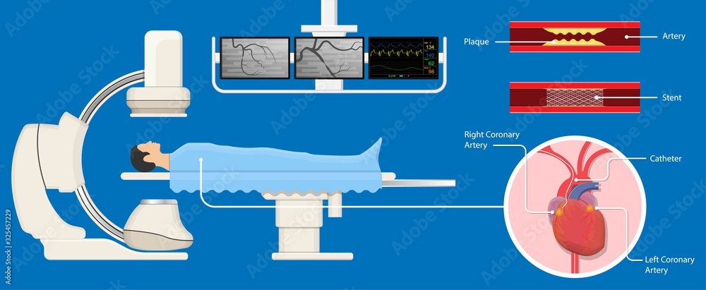 Angiography medical treatment Cardiac operation Angiogram Biopsy ...