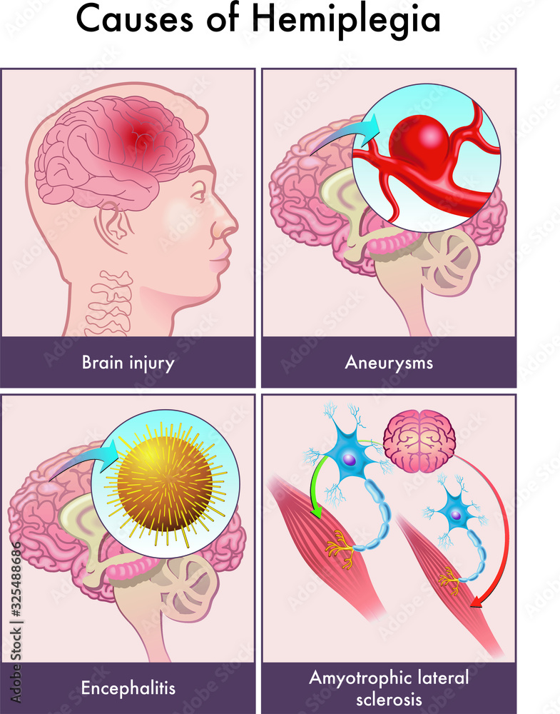 Vetor do Stock: Medical illustration for causes of hemiplegia including ...