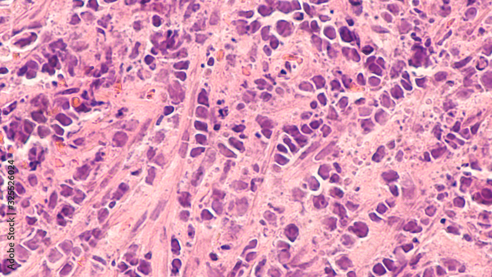 Lung Cancer Awareness; Photomicrograph of neck lymph node showing ...