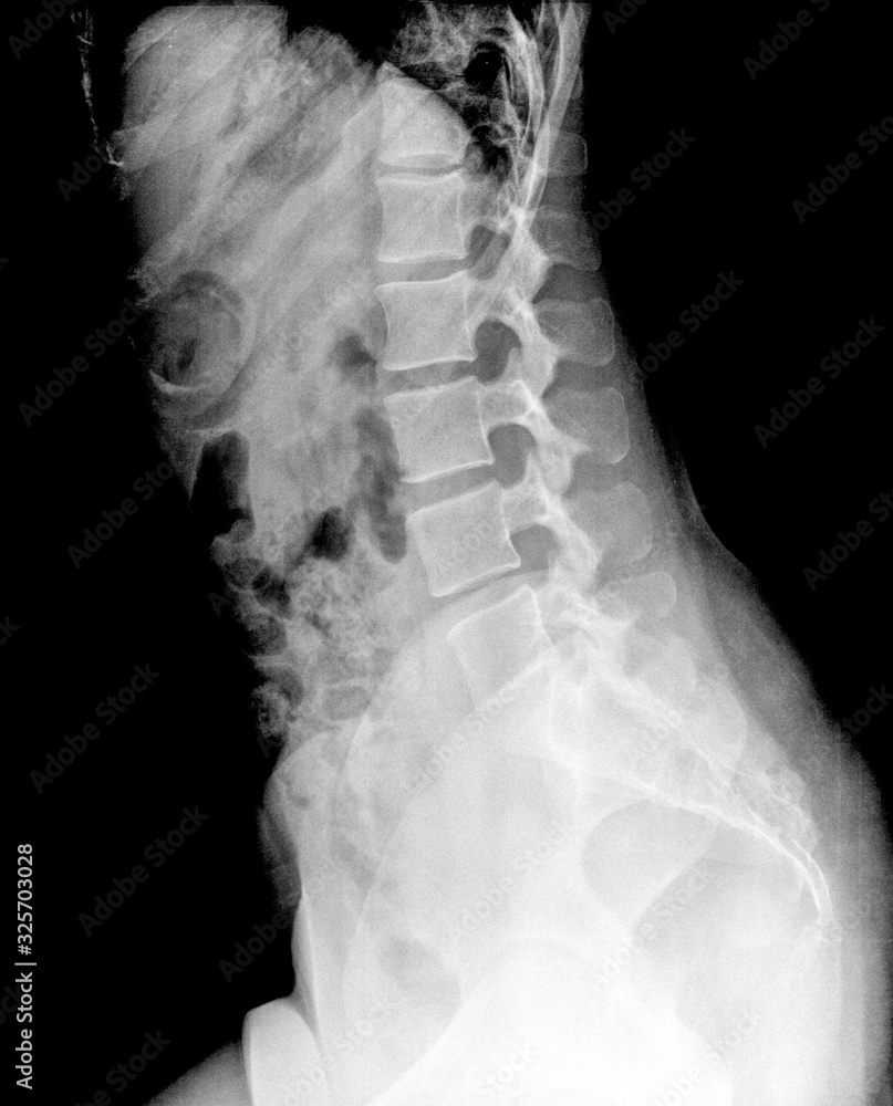 Human spine x-ray. Medical examination test scan Stock Photo | Adobe Stock