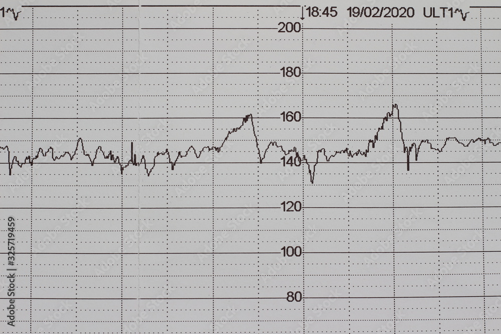 ecg graph, electrocardiogram ekg on paper Stock Photo | Adobe Stock