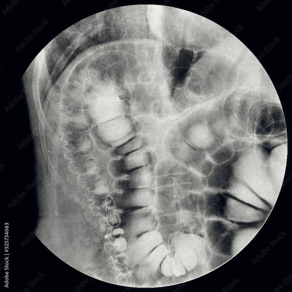 X-ray examination of the large intestine (colon). Barium enema, double ...
