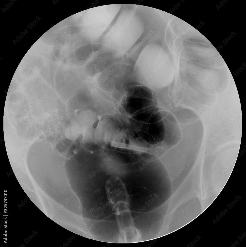 Barium enema image or colorectal x-ray view showing anatomical of large ...