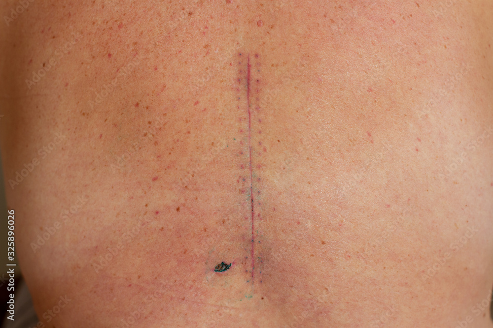 big scar from surgery to remove a tumor on the human spine Stock Photo ...
