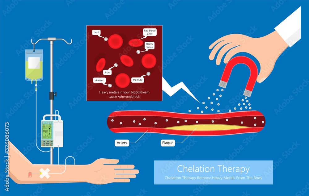 Chelation Therapy lead mercury iron arsenic ethylenediaminetetraacetic ...