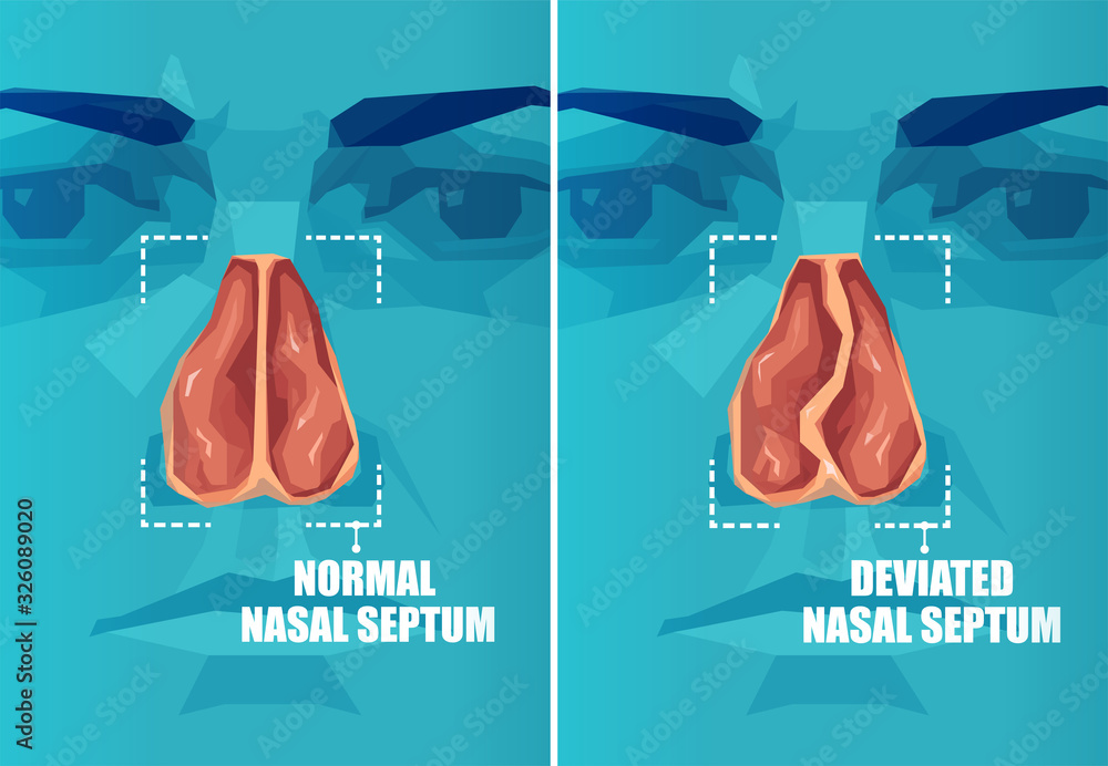 Vector cross section of face with deviated and normal nasal septum ...