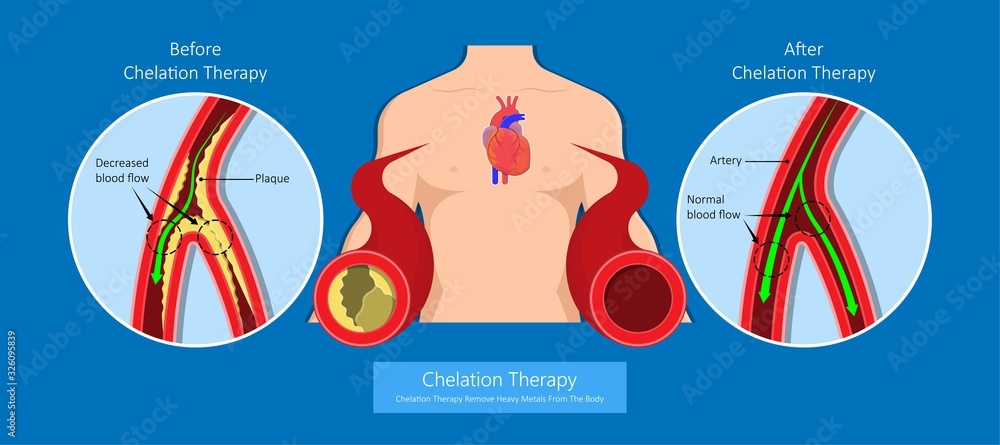 Chelation Therapy lead mercury iron arsenic ethylenediaminetetraacetic ...