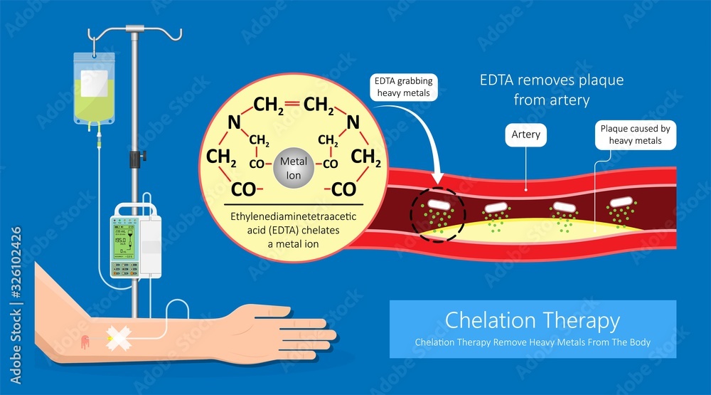 Vetor de Chelation Therapy lead mercury iron arsenic ...