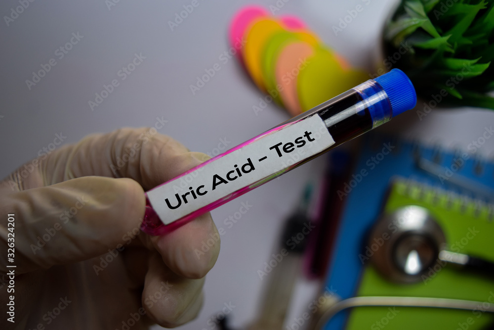 Uric Acid - Test with blood sample. Top view isolated on office desk ...