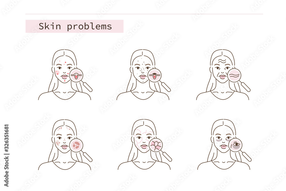 Beauty Girl Have Skin Problems. Acne, Wrinkles, Pigmentation, Dry Skin ...