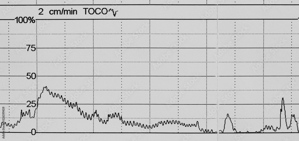 ecg graph, electrocardiogram ekg on paper Stock Photo | Adobe Stock