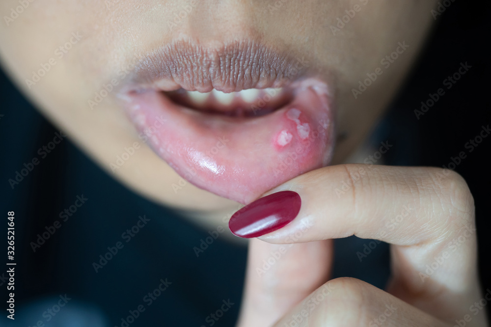 Canker Sore On Lip Swollen