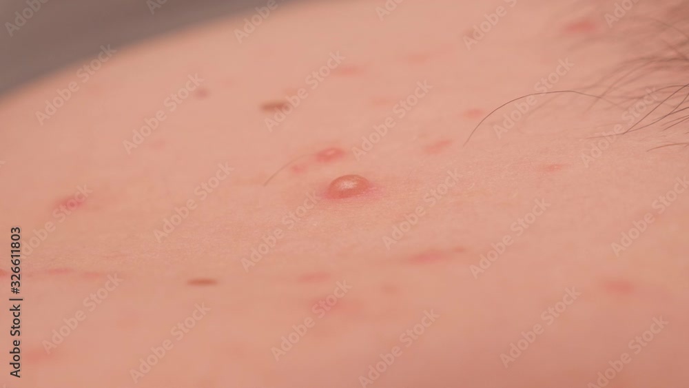 Close-up of large rashes or smallpox on the skin of an adult male. The ...