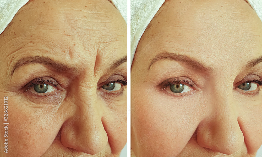 face old woman wrinkles before and after treatment Stock Photo | Adobe ...
