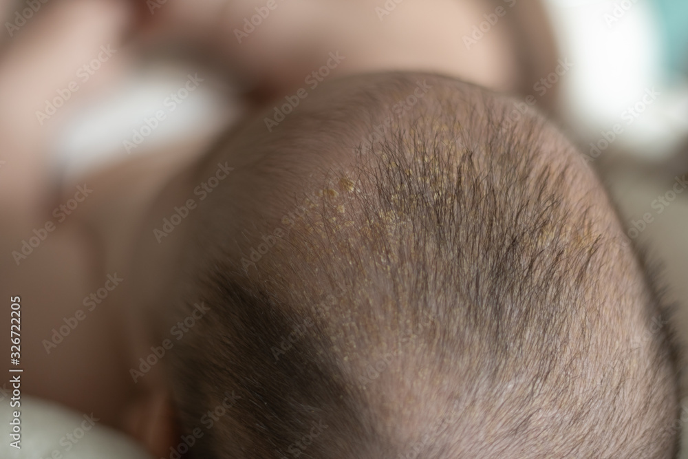 Small yellow dry peel crusts on the baby’s head. Seborrheic dermatitis ...