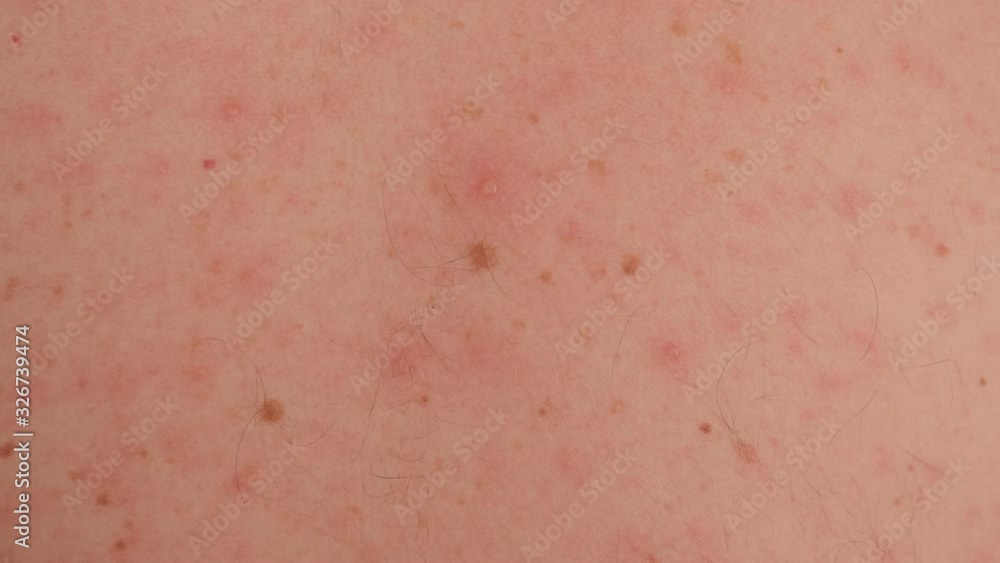 Close-up of large rashes or smallpox on the skin of an adult male. The ...