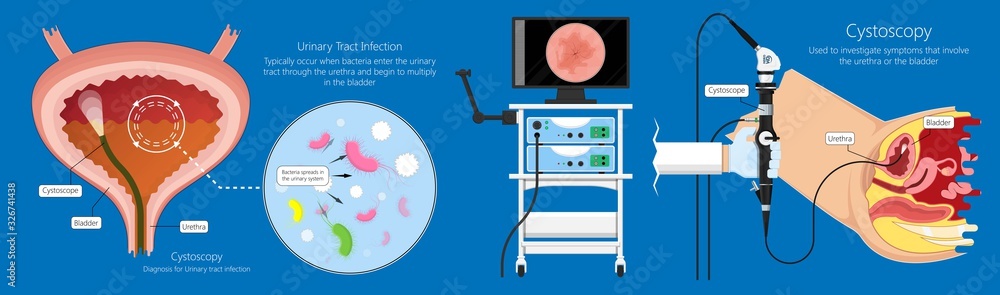 Cystoscopy diagnose bladder diseases and conditions exam treat benign ...