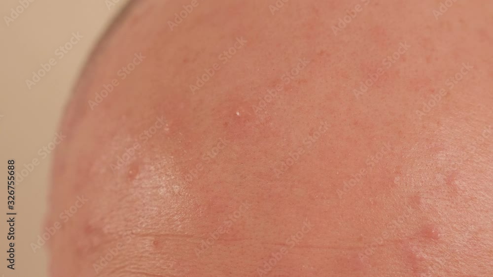 Close-up of a rash on the skin of an adult male. A man has varicella ...
