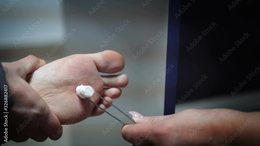Cryotherapy on a patient's foot that is infected with bacterium ulcers ...